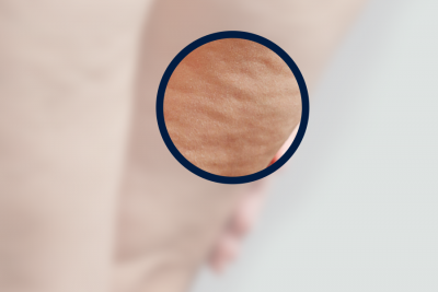 Cellulite